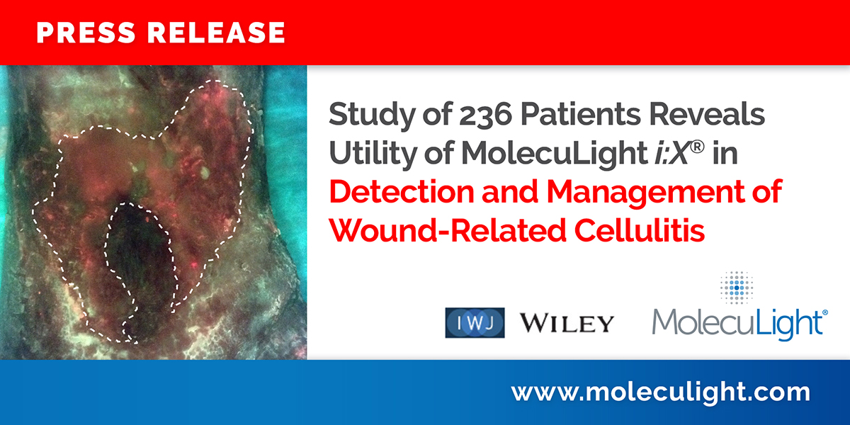 MolecuLight i:X® in Detection & Management of Cellulitis
